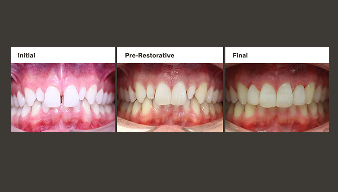Invisalign Before And After Spacing